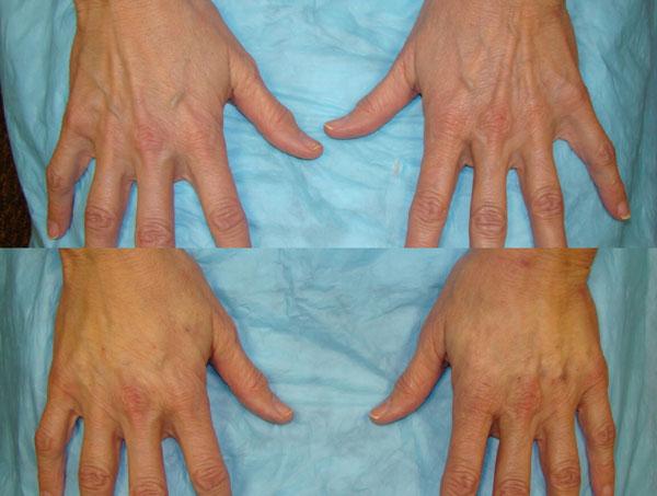 Injectable Fillers for Hand Rejuvenation - Savannah Plastic Surgery